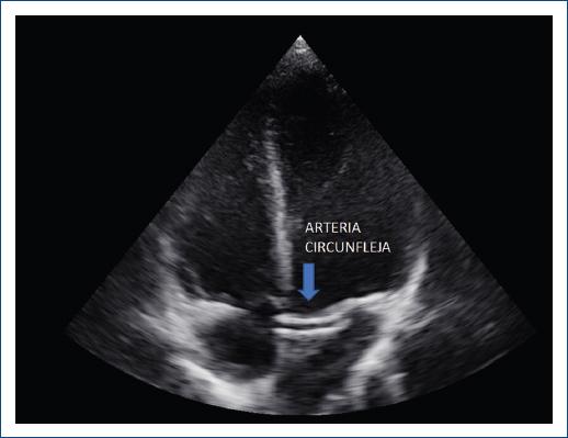 Origen aórtico anómalo de las arterias coronarias
