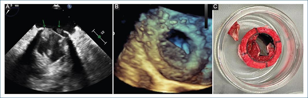 Challenges in prosthetic valvular thrombosis: imaging relevance and the ...