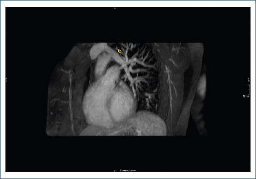 Partial anomalous pulmonary venous return: a casual finding in many cases