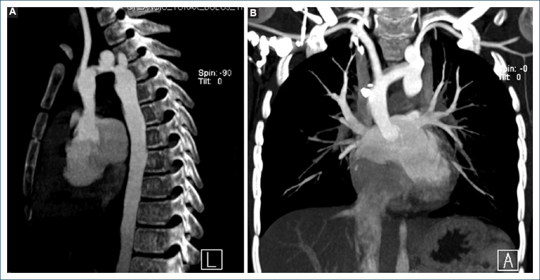 Tratamiento endovascular exitoso de aneurisma del arco aórtico en un ...