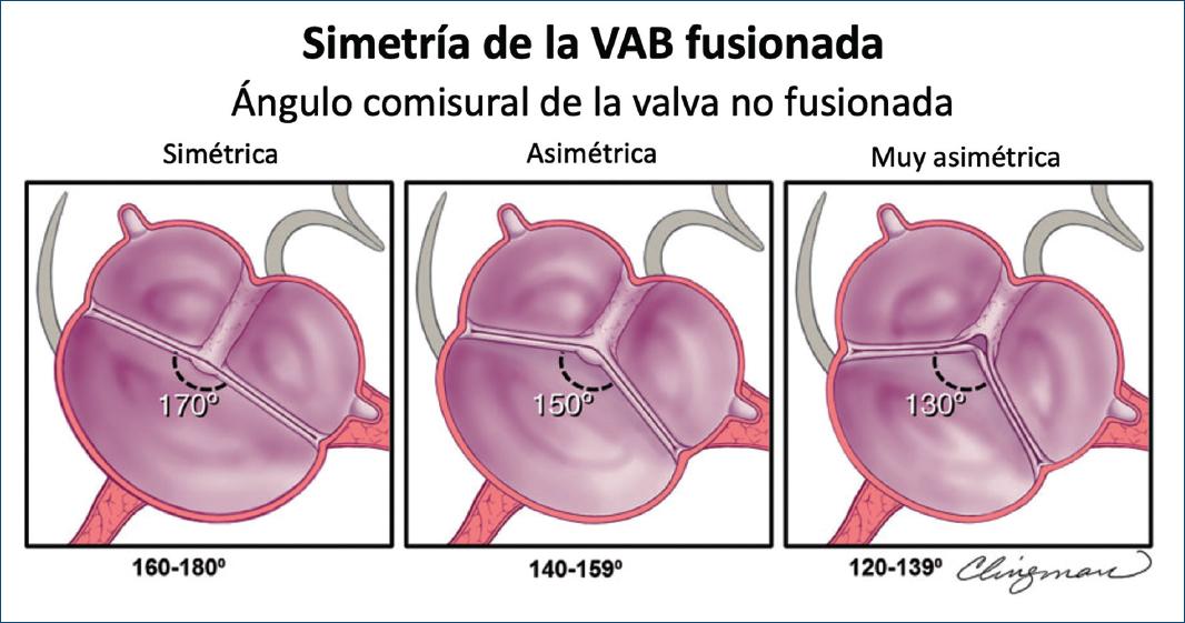 Anatomía De La Valva De La Válvula Aórtica