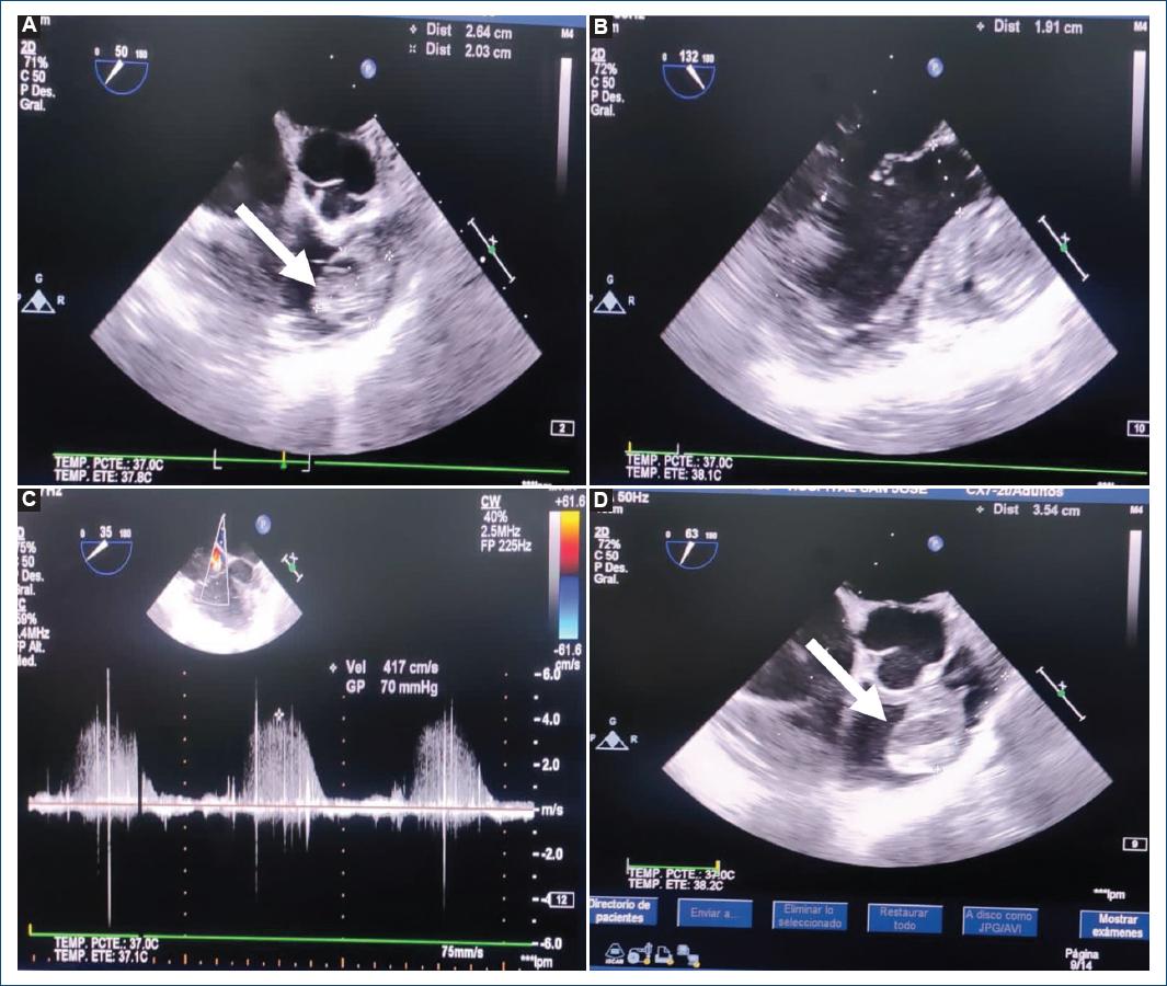 Right ventricular capillary hemangioma as a cause of congestive heart ...