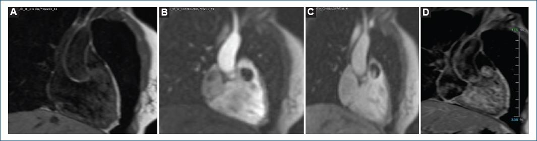 Right ventricular capillary hemangioma as a cause of congestive heart ...