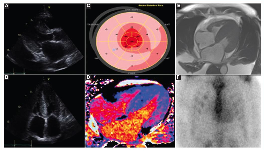 Multimodality imaging approach in light chain (AL) cardiac amyloidosis ...