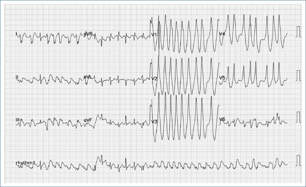 Pre-excited atrial fibrillation: a potentially lethal electrical phenomenon