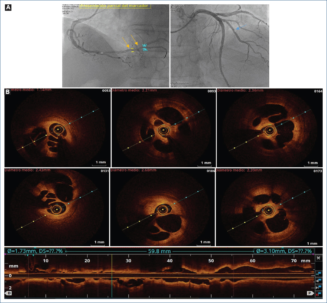 Honeycomb-like structure in patient with multivessel disease: case report
