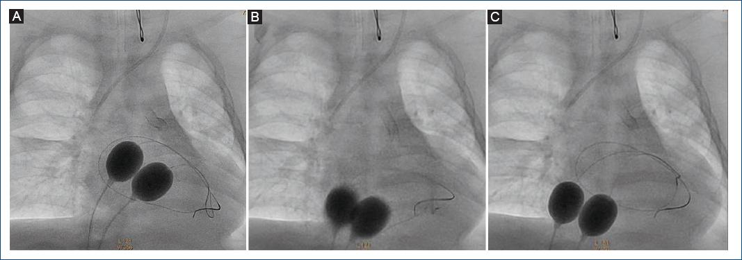 Double "dynamic" balloon atrial septostomy. New modification of Dr ...