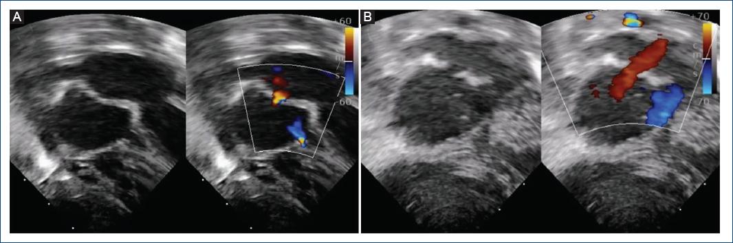 Double "dynamic" balloon atrial septostomy. New modification of Dr ...