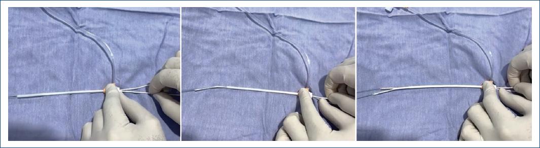 Double "dynamic" balloon atrial septostomy. New modification of Dr ...