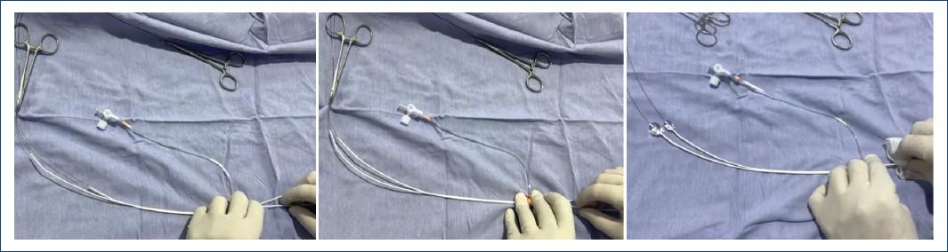Double "dynamic" balloon atrial septostomy. New modification of Dr ...