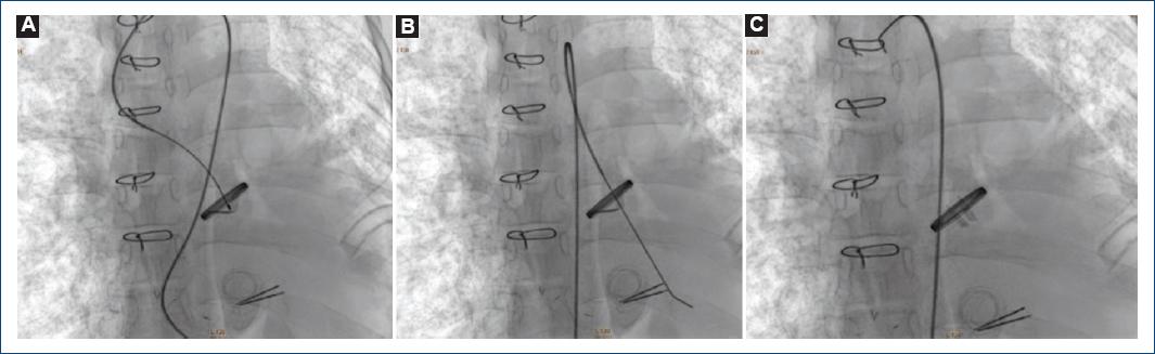 Transcatheter resolution of mechanical aortic valve dysfunction in a ...