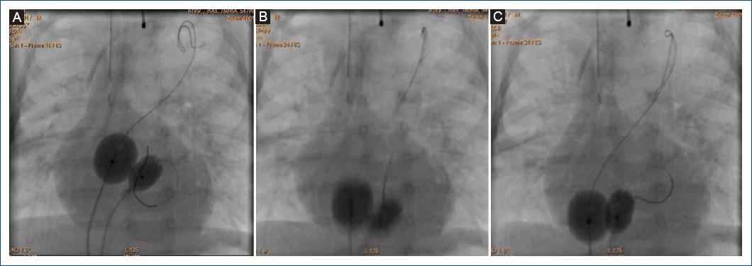 Double "dynamic" balloon atrial septostomy. New modification of Dr ...