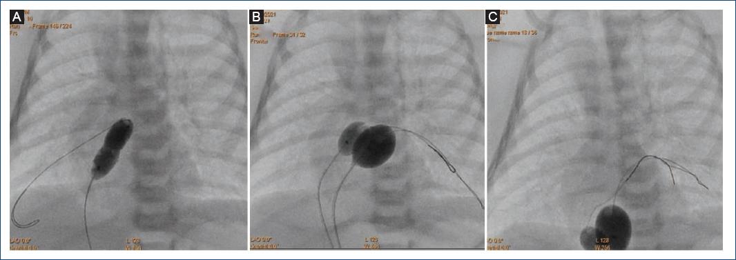 Double "dynamic" balloon atrial septostomy. New modification of Dr ...