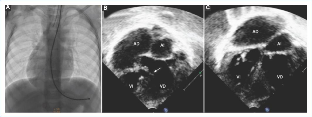 Straddling of the mitral valve in the set of situs solitus in ...