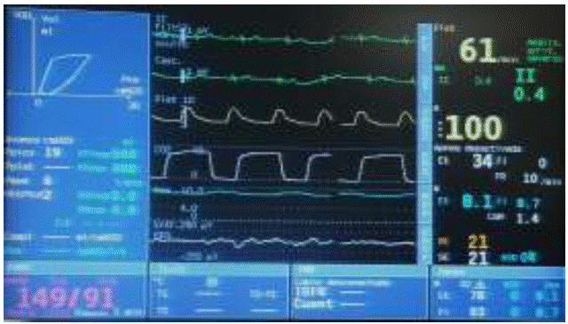 Anestesia en liposucción de grandes volúmenes