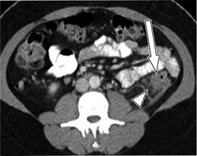Estadio de Hinchey más frecuentemente encontrado en pacientes del ...