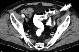 Estadio de Hinchey más frecuentemente encontrado en pacientes del ...