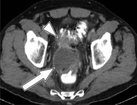 Estadio de Hinchey más frecuentemente encontrado en pacientes del ...