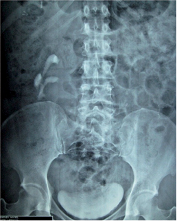 Ectopia renal cruzada y fusionada