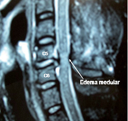 Síndrome medular del cordón posterior