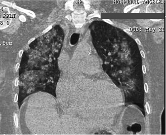 Granulomatosis con poliangitis