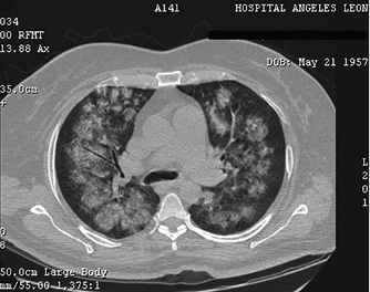 Granulomatosis con poliangitis