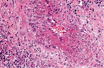 Granulomatosis con poliangitis