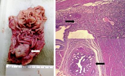 Páncreas ectópico en antro gástrico