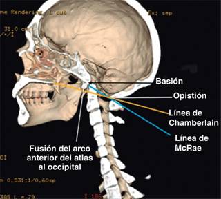 Asimilación atlanto-occipital