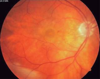 Degeneración macular relacionada con la edad