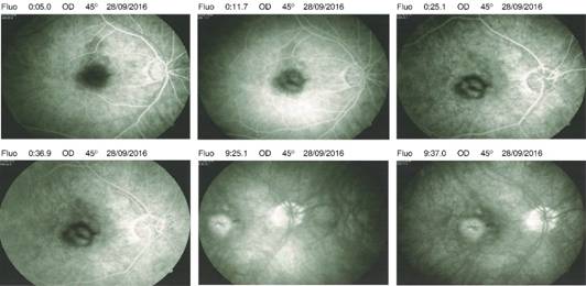 Degeneración macular relacionada con la edad