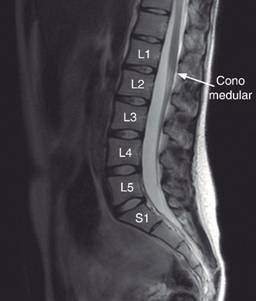 Localización del cono medular por resonancia magnética en una población ...