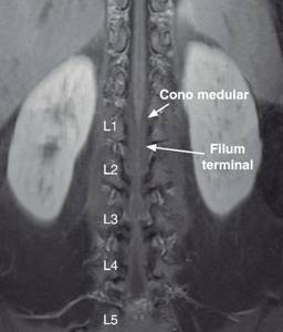 Localización del cono medular por resonancia magnética en una población ...