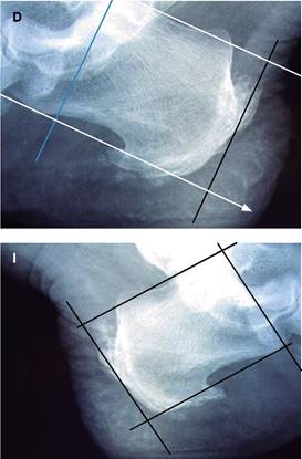 Entesopatías crónicas del calcáneo