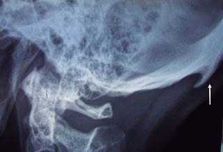 Entesofito de la protuberancia occipital externa