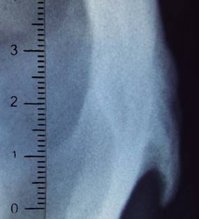 Entesofito de la protuberancia occipital externa