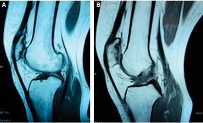 Síndrome femoropatelar por condromalacia rotuliana grado IV