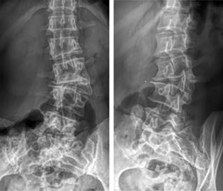 Hemivértebra, deformidad congénita de la columna vertebral