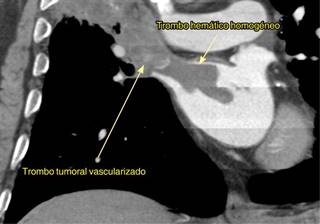 Trombo tumoral en la vena pulmonar superior derecha