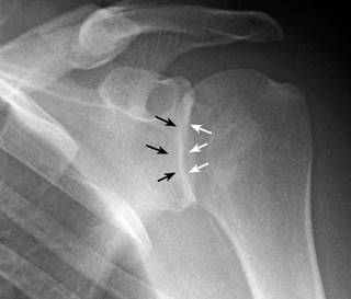 Luxación posterior del hombro bloqueada con lesión de McLaughlin