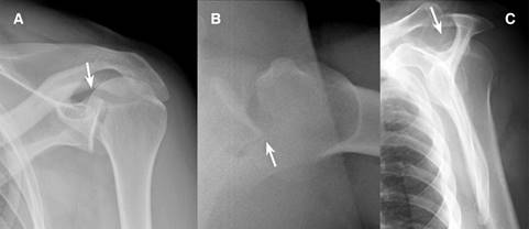 Luxación posterior del hombro bloqueada con lesión de McLaughlin