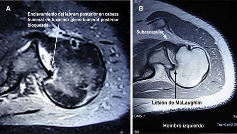 Luxación posterior del hombro bloqueada con lesión de McLaughlin