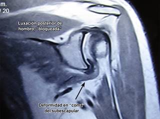 Luxación posterior del hombro bloqueada con lesión de McLaughlin