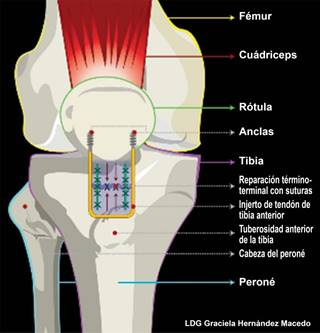 Lesión multiligamentaria de rodilla