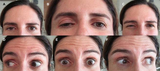 Síndrome de Horner secundario a cirugía de columna cervical: una ...