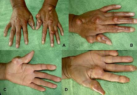 Calcinosis severa en manos como parte del síndrome de CREST