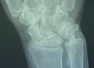 Calcinosis severa en manos como parte del síndrome de CREST