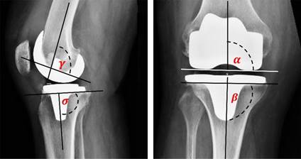 Relación entre la alineación de los componentes protésicos de rodilla y ...