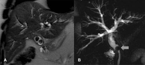Diagnóstico de obstrucción de la vía biliar por colangiorresonancia ...