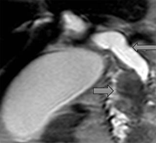 Diagnóstico de obstrucción de la vía biliar por colangiorresonancia ...